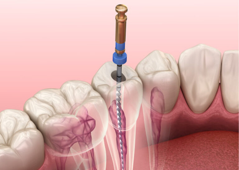 Endodontie – Wurzelkanalbehandlung » Zahnärzte im Fichtelgebirge