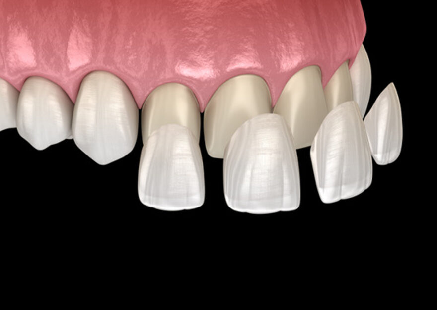 Veneers – einfach schöne Zähne » Zahnärzte im Fichtelgebirge